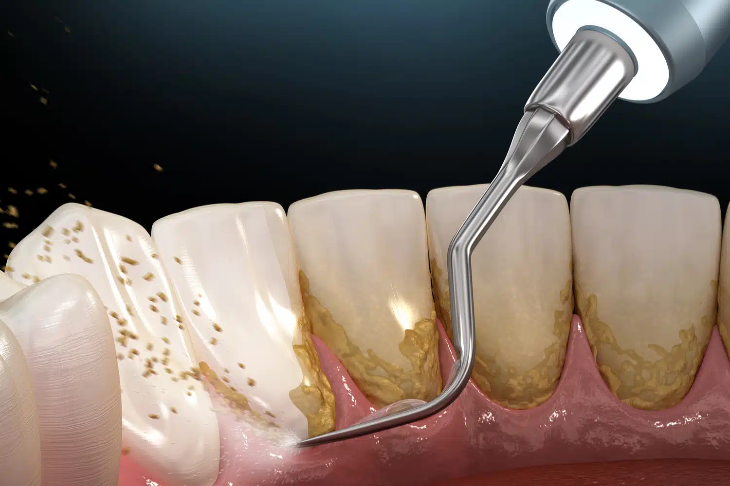 Why Dental Scaling is Crucial for Maintaining Optimal Oral Health ...