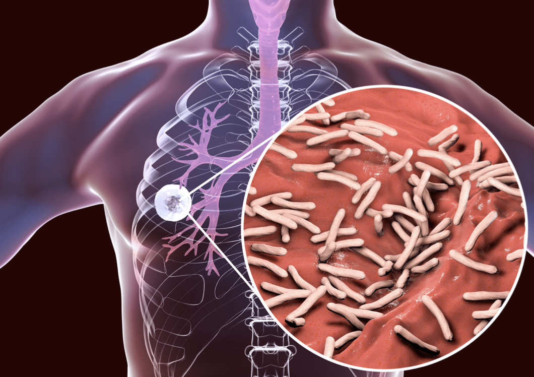 Myths and Facts About Tuberculosis — BIMC Hospital Bali