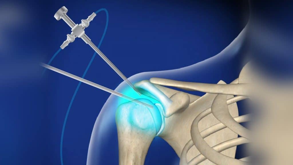 Everything You Need to Know About Knee & Shoulder Arthroscopy — BIMC ...